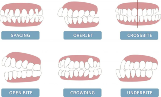 Braces Aurora CO | Straighten Crooked Teeth | Teeth Braces